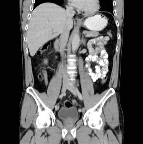 What Is A Liver Ct Scan Two Views
