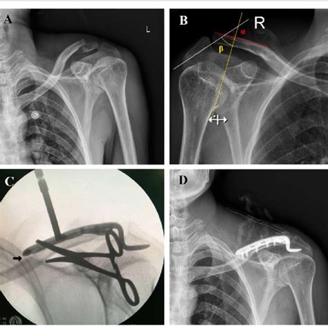 Case 1 A 30 Year Old Man With Left Distal Clavicle Fracture Treated