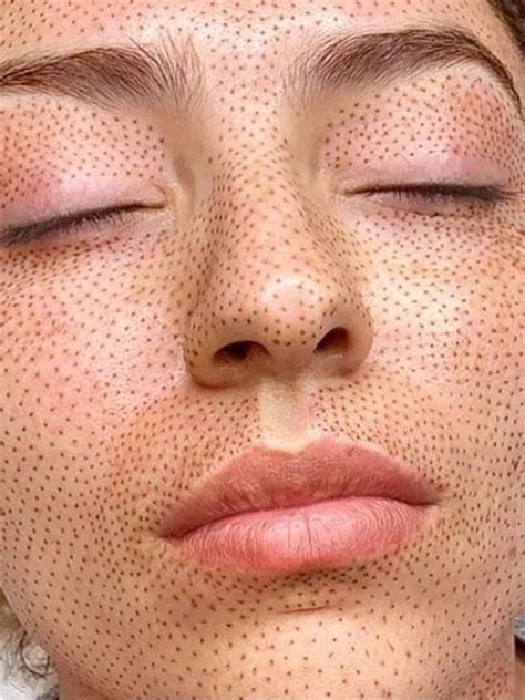 Fibroblast Plasma Pen Skin Tightening Artofit