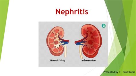 Nephritis Slide Share Pptpptx Definition Types Sign Symptom