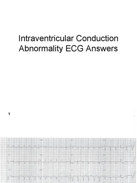 Intraventricular Conduction Abnormality Ecg Pdf Electrocardiography