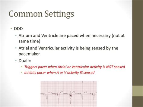 Ekgs And Pacemakers Cooper University Hospital Ppt Download
