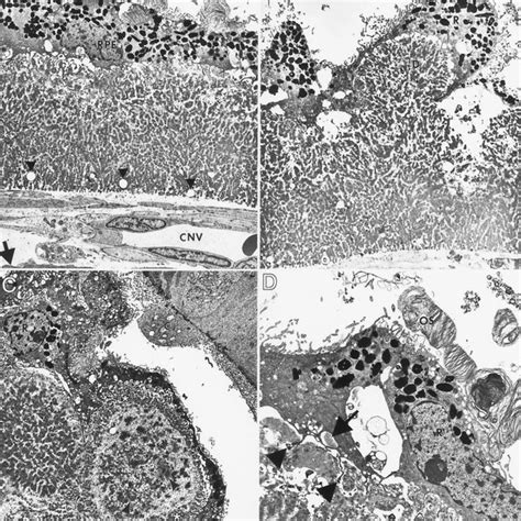 Electron Microscopy Of Donor Retina A The Sub Retinal Pigment