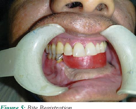 Figure 5 From Marginal Mandibulectomy Defect Rehabilitated With Cast