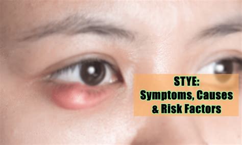Stye Symptoms Causes And Risk Factors Of This Infection