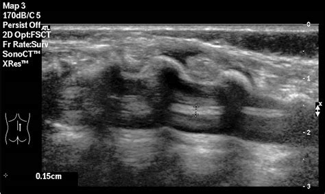A Sagittal Spinal Ultrasound Showing Lipoma Of The Filum Unusual