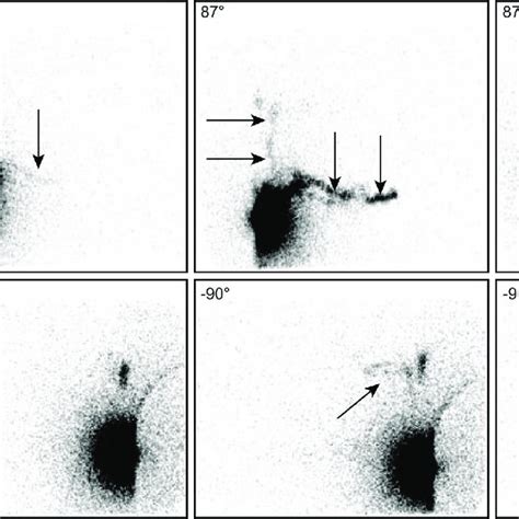 Contrast Enhanced 3d Frontal Mr Lymphography Maximum Intensity Download Scientific Diagram