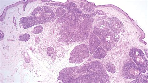 Unilateral Facial Papules And Plaques Mdedge