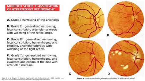 Hypertensive Retinopathy 2pptx