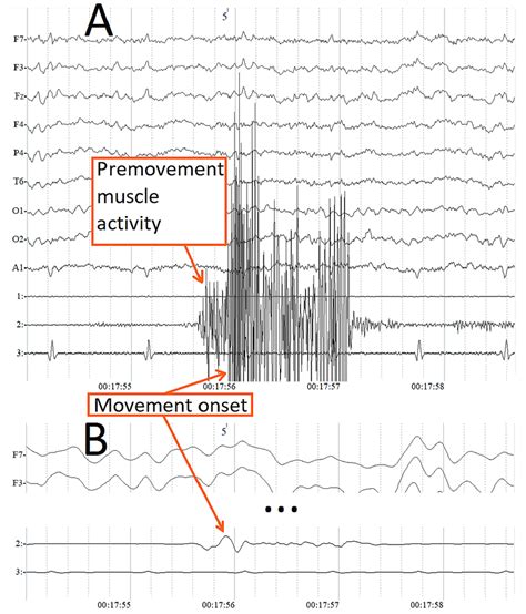 Real Movement Detection Left Hand Detection Using The Emg Signal A Download Scientific