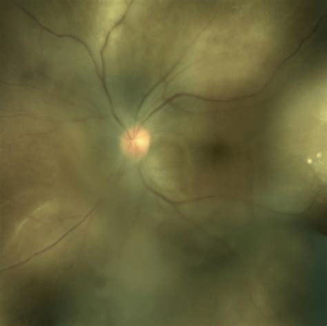 19 Syphilis Ento Key