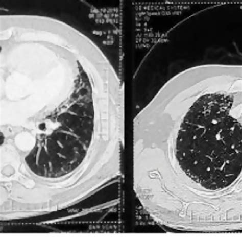 High Resolution Computerized Tomography Hrct Chest In Rheumatoid