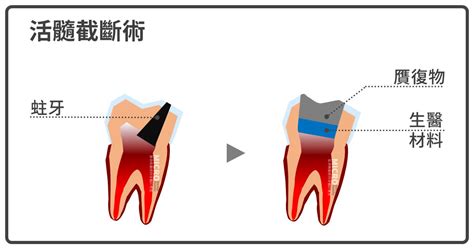 根管治療，抽神經，牙髓治療，活髓治療、牙根尖切除手術。努力把手繪圖，改成ppt！ 顯微根管治療張添皓醫師