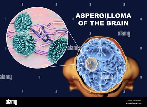 Aspergilloma Of The Brain And A Close Up View Of Aspergillus Fungi
