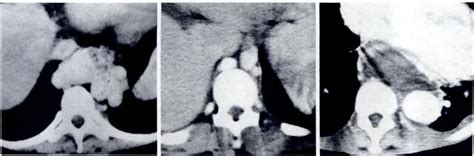 7 Severe Esophageal Varices Demonstrated At Gastroesophageal Junction