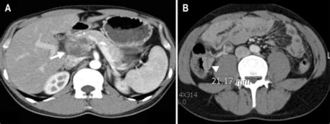An Enlarged Lymph Node Was Found In The Periportal Area Open I