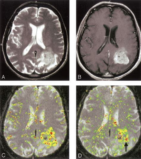 Figure 4 From Mr Imaging With Glioma Grade Susceptibility Contrast Enhanced Perfusion Vascular