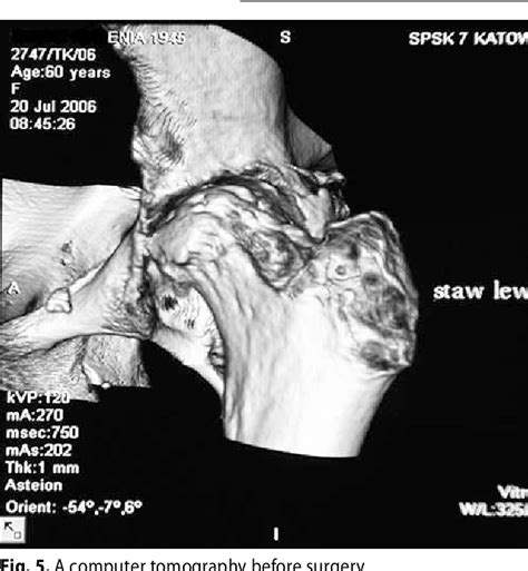 Figure 3 From Bilateral Neurogenic Hip Arthropathy Semantic Scholar