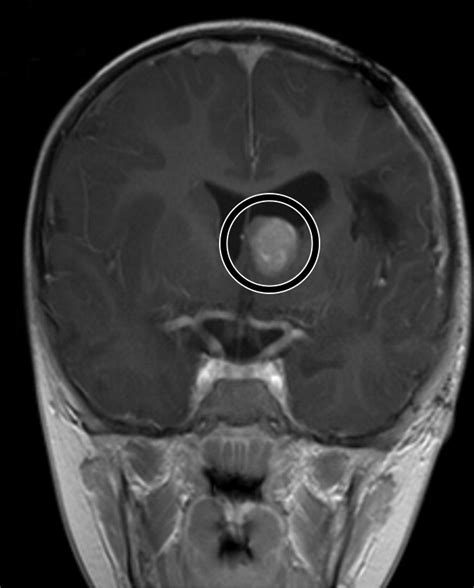Bone Lesions Tuberous Sclerosis