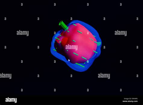 Prostate Cancer Radiotherapy Surgery Radiologist Inserting A Hollow