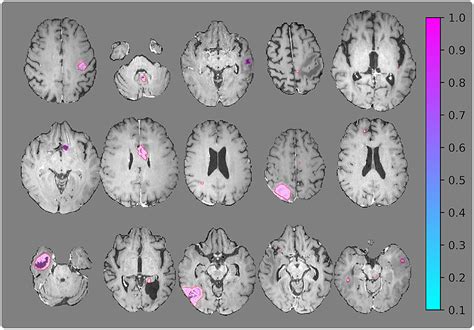 frontiers 2 5d and 3d segmentation of brain metastases with deep