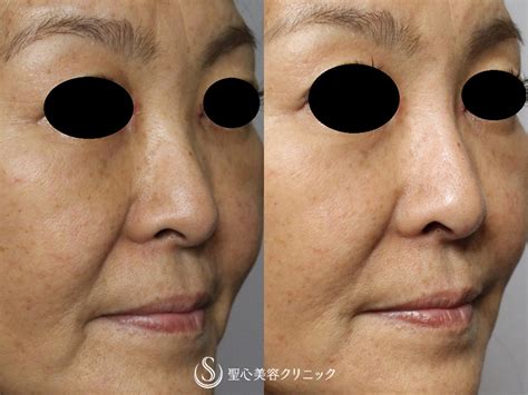 【50代女性・ヒアルロン酸でダウンタイムなしで鼻筋を高く】クレヴィエル注入（処置直後） 症例写真 美容整形、美容外科なら聖心美容クリニック