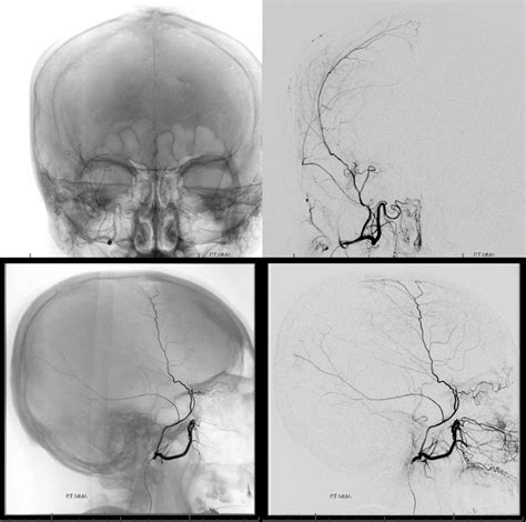 Subdural Embolization Of Meningolacrimal Variant With Nbca