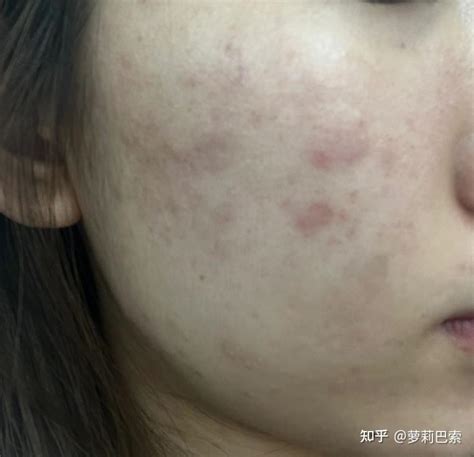 你们有没有用过哪些真正好用的祛痘产品吗？ 知乎