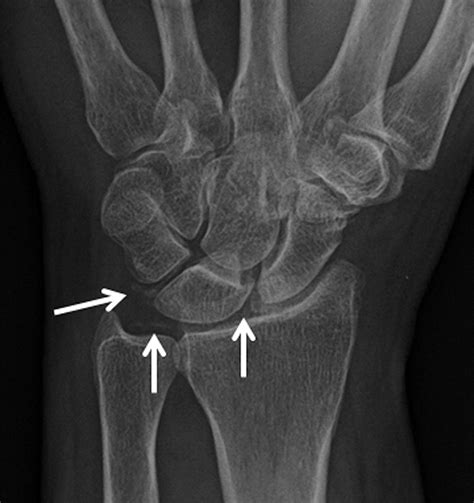 High Resolution US Of Rheumatologic Diseases RadioGraphics