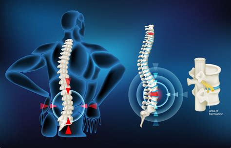 ¿qué Es Una Hernia Discal Mov Rehabilitación