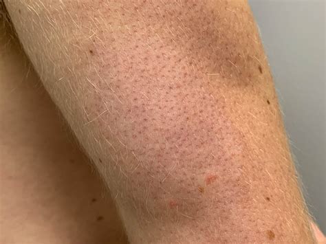 Keratosis Pilaris Spot Check Clinic Skin Cancer And Aesthetics