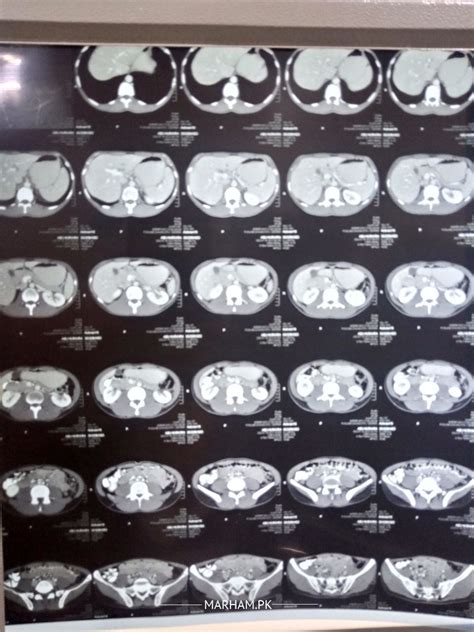 Ask A General Physician Online For Ct Abdomen And Pelvis