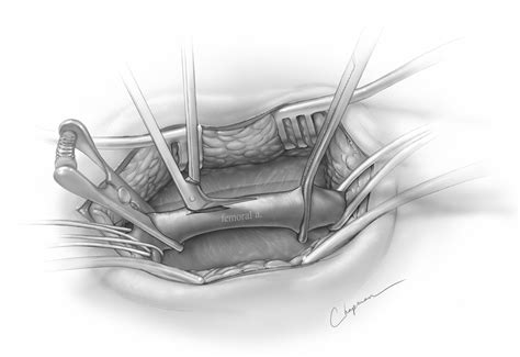Fem Fem Bypass Surgery Behance