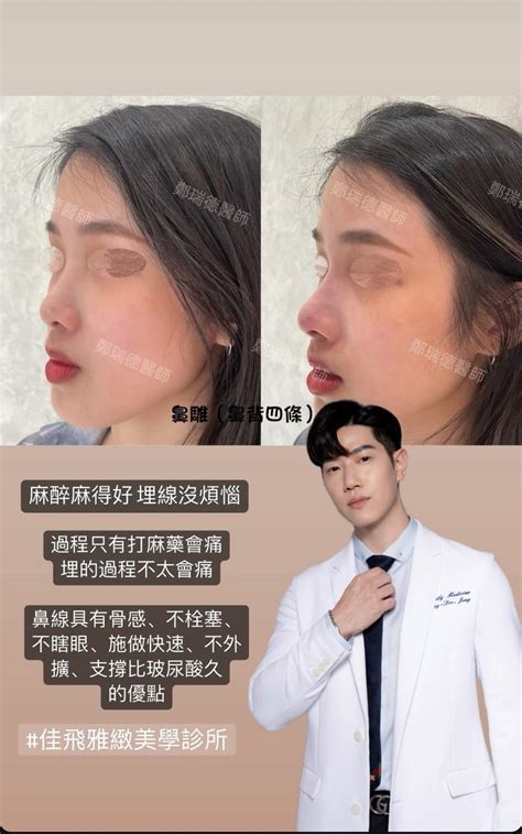 《鼻線與玻尿酸之爭》 鼻整型的最佳解當然是手術無庸置疑。 但就微整型領域而言， 我會比較推薦「鼻雕」 相較玻尿酸、異體增皮粉有血管栓塞、瞎眼