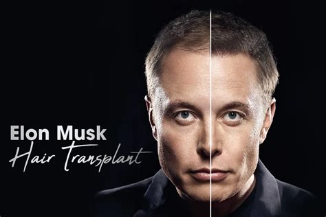 Elon Musk Hair Transplant International Plus