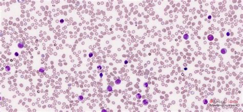 Cml In Accelerated Phase Learnhaem Haematology Made Simple