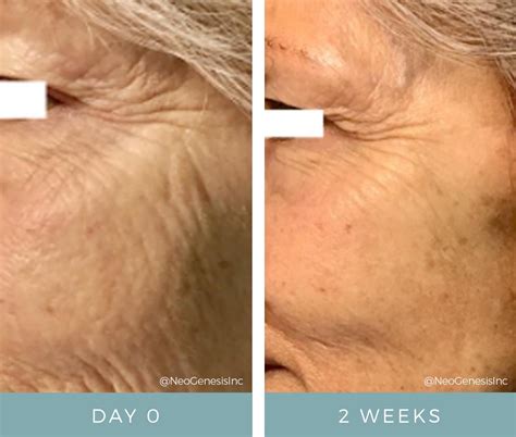 Before After Fibroblast Skin Care Products Post Fibroblast