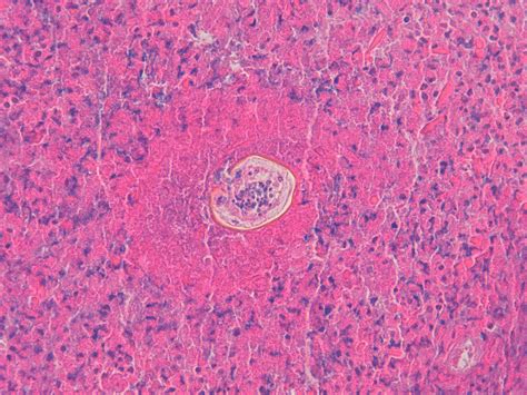 How Is The Apparence Of A S Haematobium Egg In A Rectal Biopsy