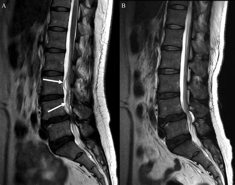 Immediate Postoperative Mri Findings After Lumbar Decompression Surgery