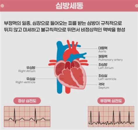 고혈압·심부전 있다면 심방세동 치료 병행해야” 제노메딕스
