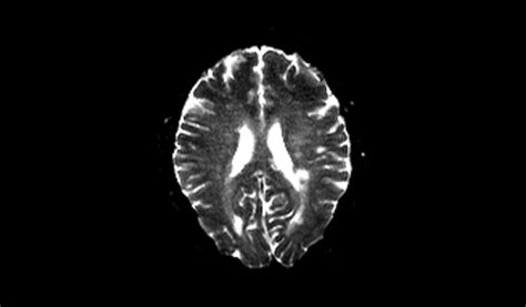 Multiple Sclerosisms Mri Radiology Article On Multiple Sclerosis