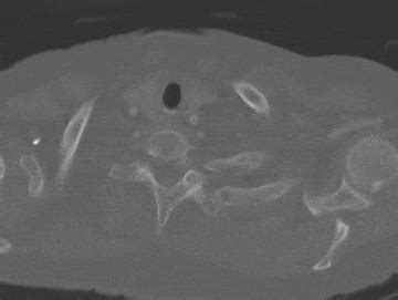 GitHub Eelvira LungSegmentation Lung Segmentation