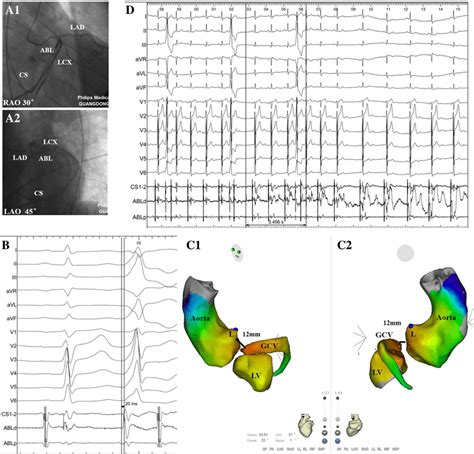 Fluoroscopy Activation And 3 Dimensional Mapping In A 55 Year Old Man