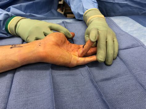Dupuytrens Contracture Denver Colorado — Dr Nick Golinvaux