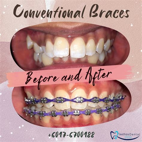 Conventional Braces Use Metal Teethos Dental Clinic Facebook