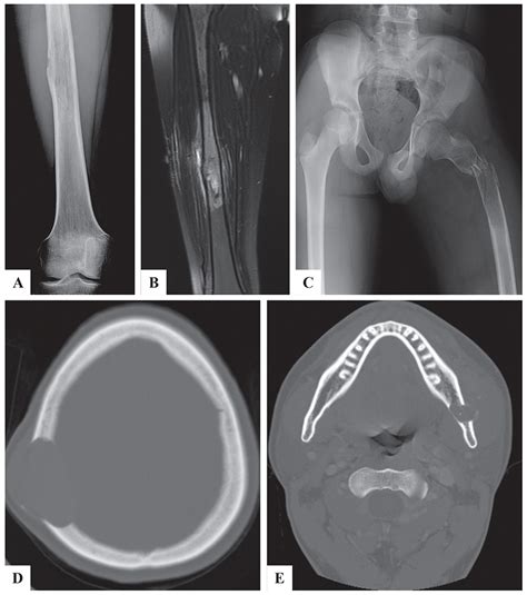 Clinical And Molecular Characterization Of Primary Sclerosing