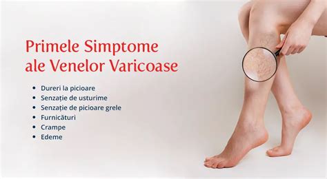 Ce Sunt Varicele La Picioare