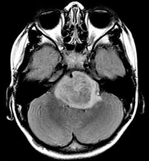 Diffuse Intrinsic Pontine Glioma News Research Articles