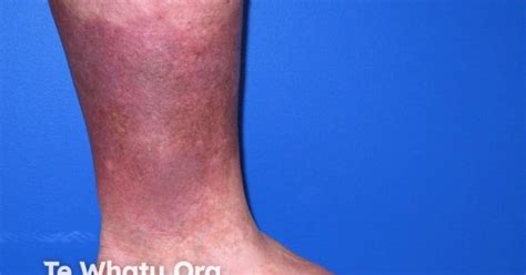 Dermnet® Acute Lipodermatosclerosis Image