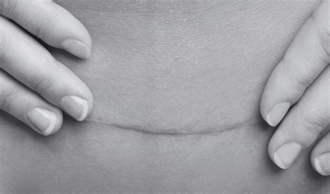 C Section Scar Reduction Treatment Midtown Nyc — Central Park Laser
